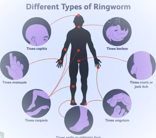 Dermatophyte Infections (Ringworm) | eMedicineHub